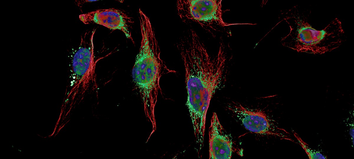 Molecule driving brain cancer cell survival could lead to future ...